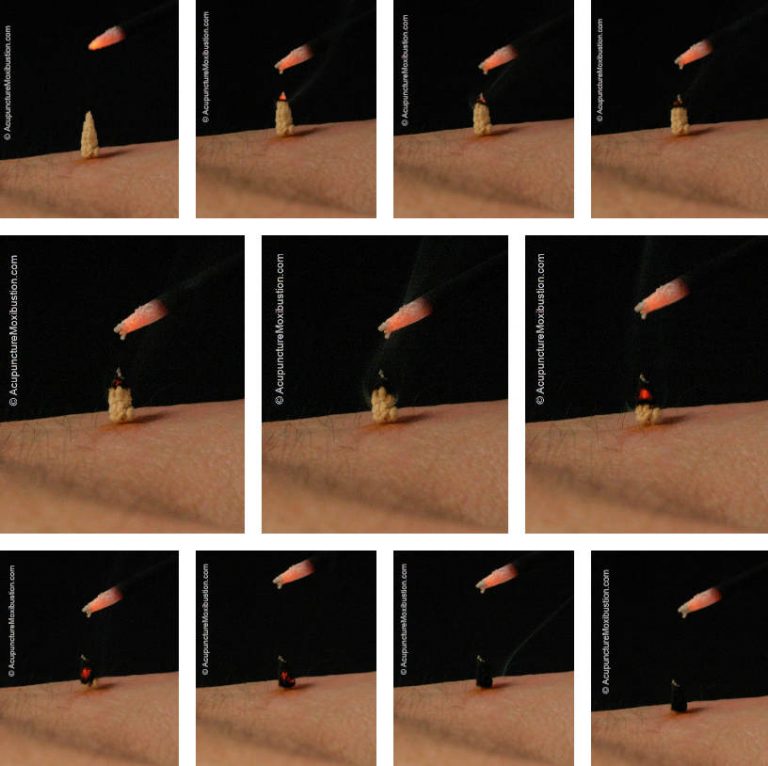 Moxibustion - Moxa Therapy